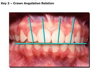 Andrews' six keys to normal occlusion | PDF
