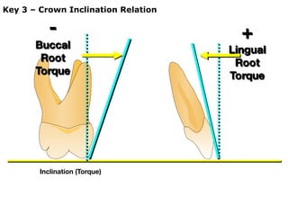 Andrews' six keys to normal occlusion | PDF