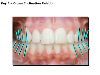 Andrews' six keys to normal occlusion | PDF