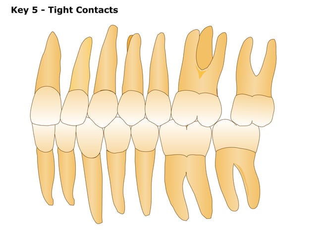Andrews' six keys to normal occlusion | PDF | Dental Health | Diseases ...