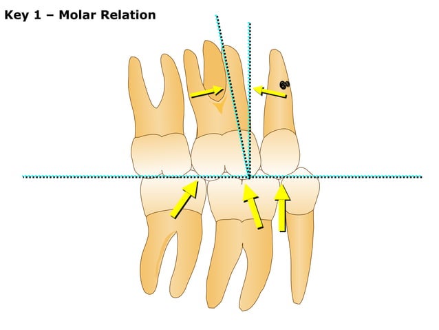 Andrews' six keys to normal occlusion | PDF | Dental Health | Diseases ...