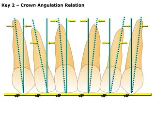 Andrews' six keys to normal occlusion | PDF