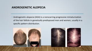 Androgenetic alopecia | PPTX