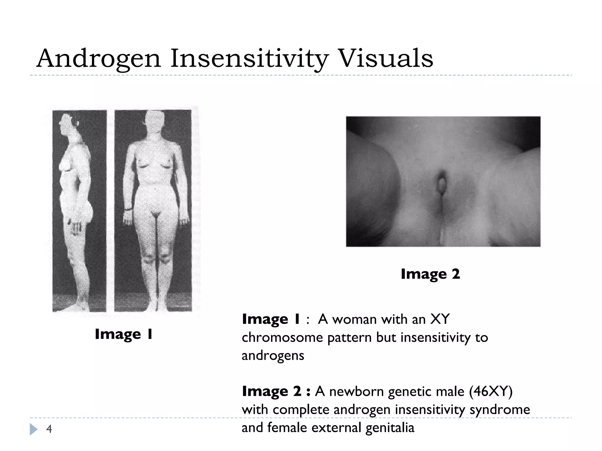 Androgen+Insensitivity | PPT