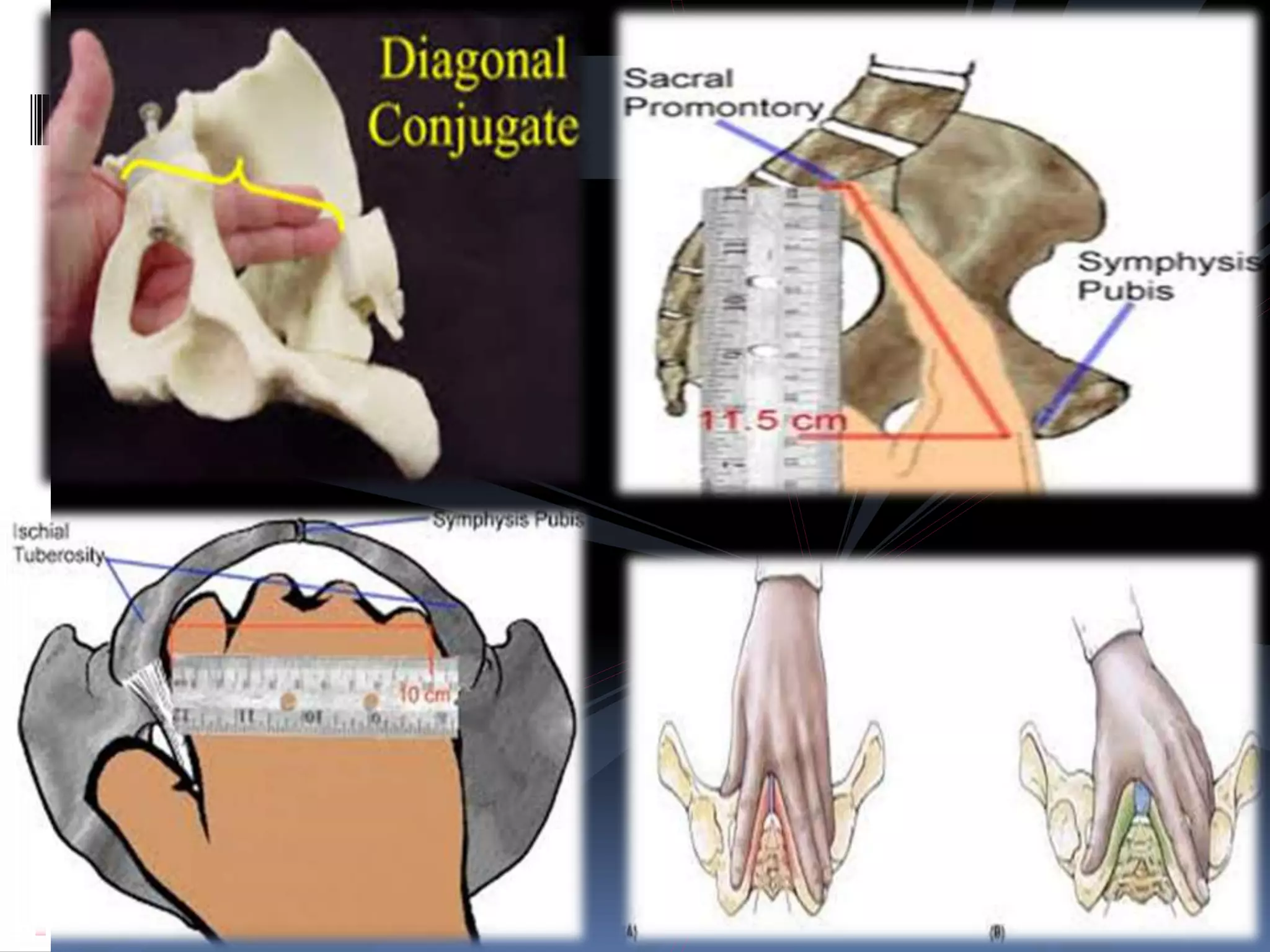 Android pelvis | PPTX