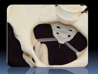 Android pelvis | PPTX