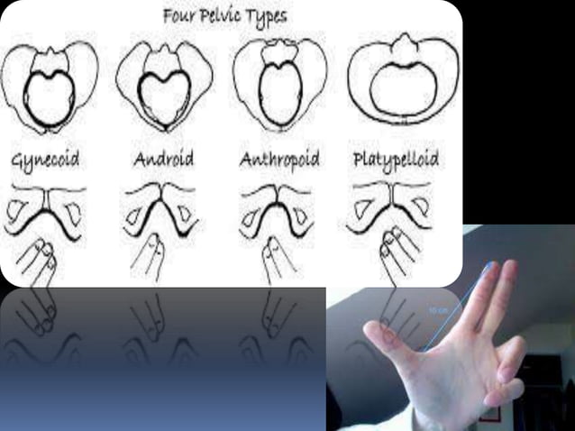 Android pelvis | PPTX