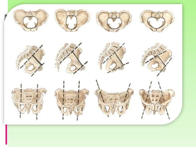 Android pelvis | PPTX
