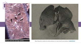 Síndrome de Hamman Rich (Fibrosis intersticial idiopática) | PPTX