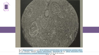 Síndrome de Hamman Rich (Fibrosis intersticial idiopática) | PPTX