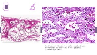 Síndrome de Hamman Rich (Fibrosis intersticial idiopática) | PPTX