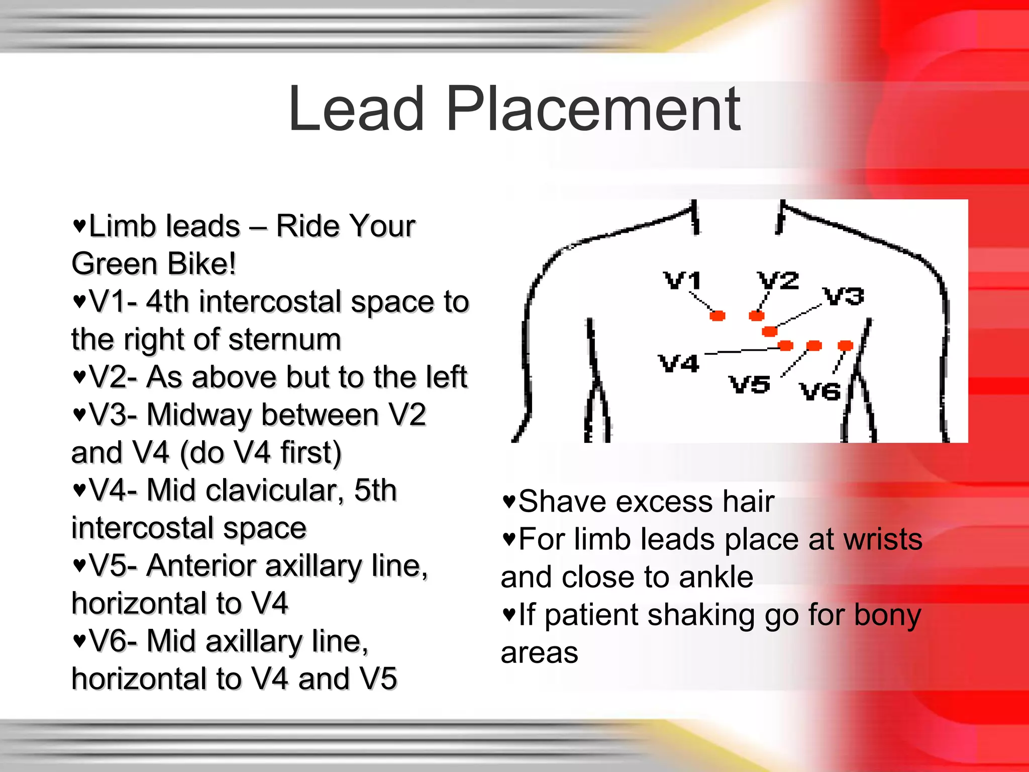 An ECG workshop | PPT