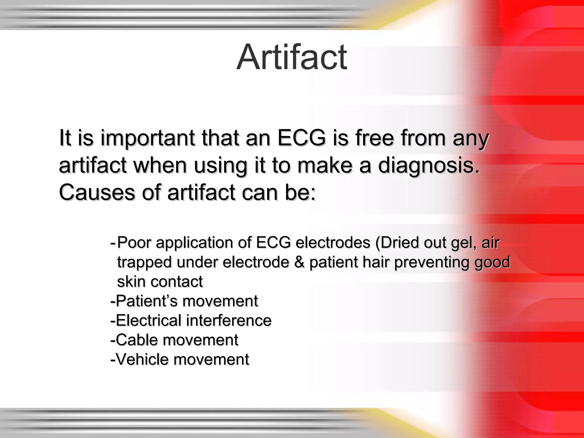 An ECG workshop | PPT