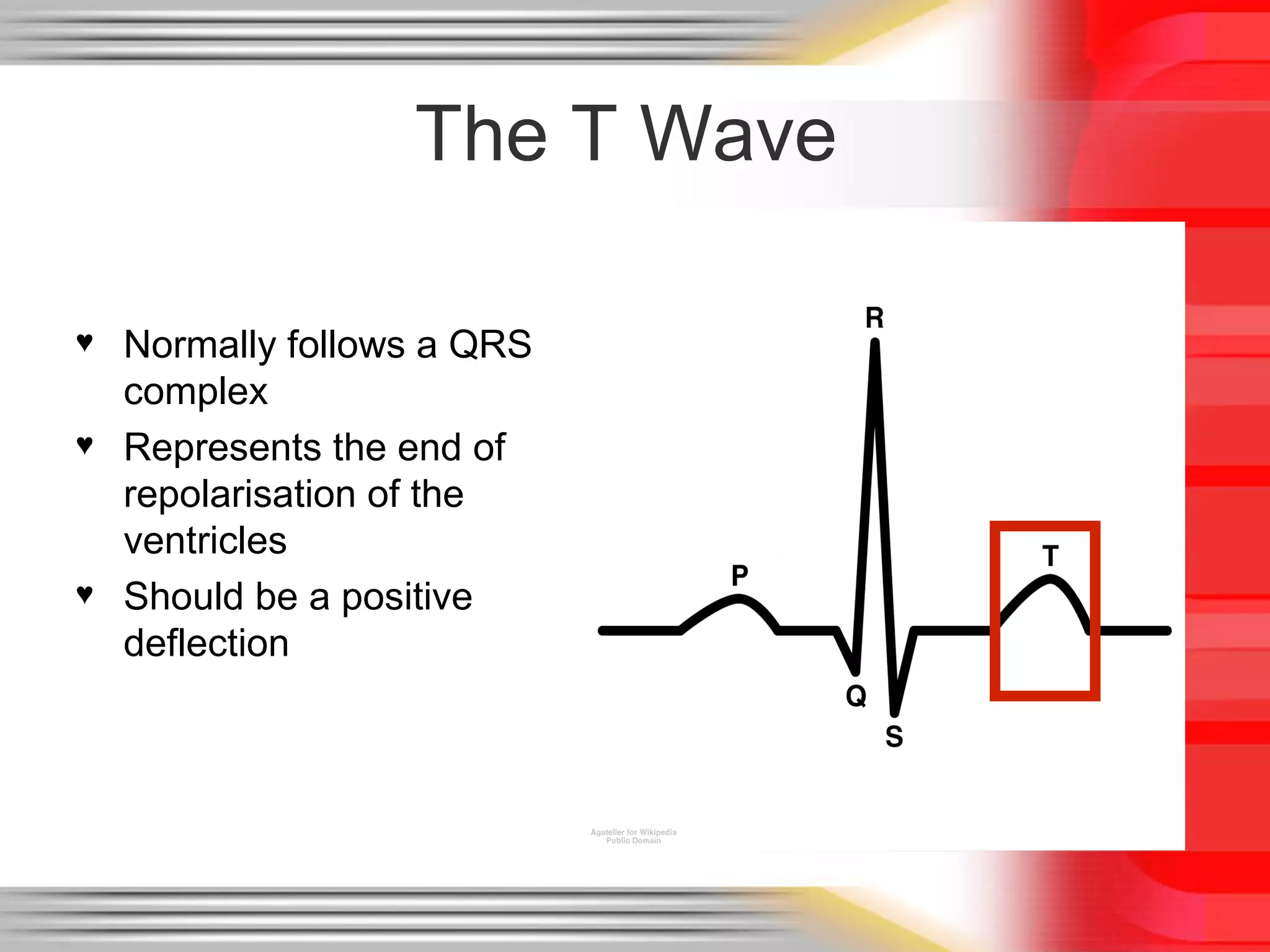 An ECG workshop | PPT
