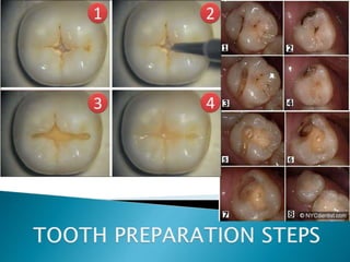 Fundamentals of tooth preparation | PPTX