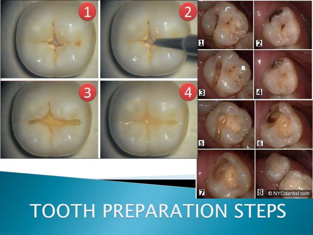 Fundamentals of tooth preparation | PPTX | Dental Health | Diseases and ...
