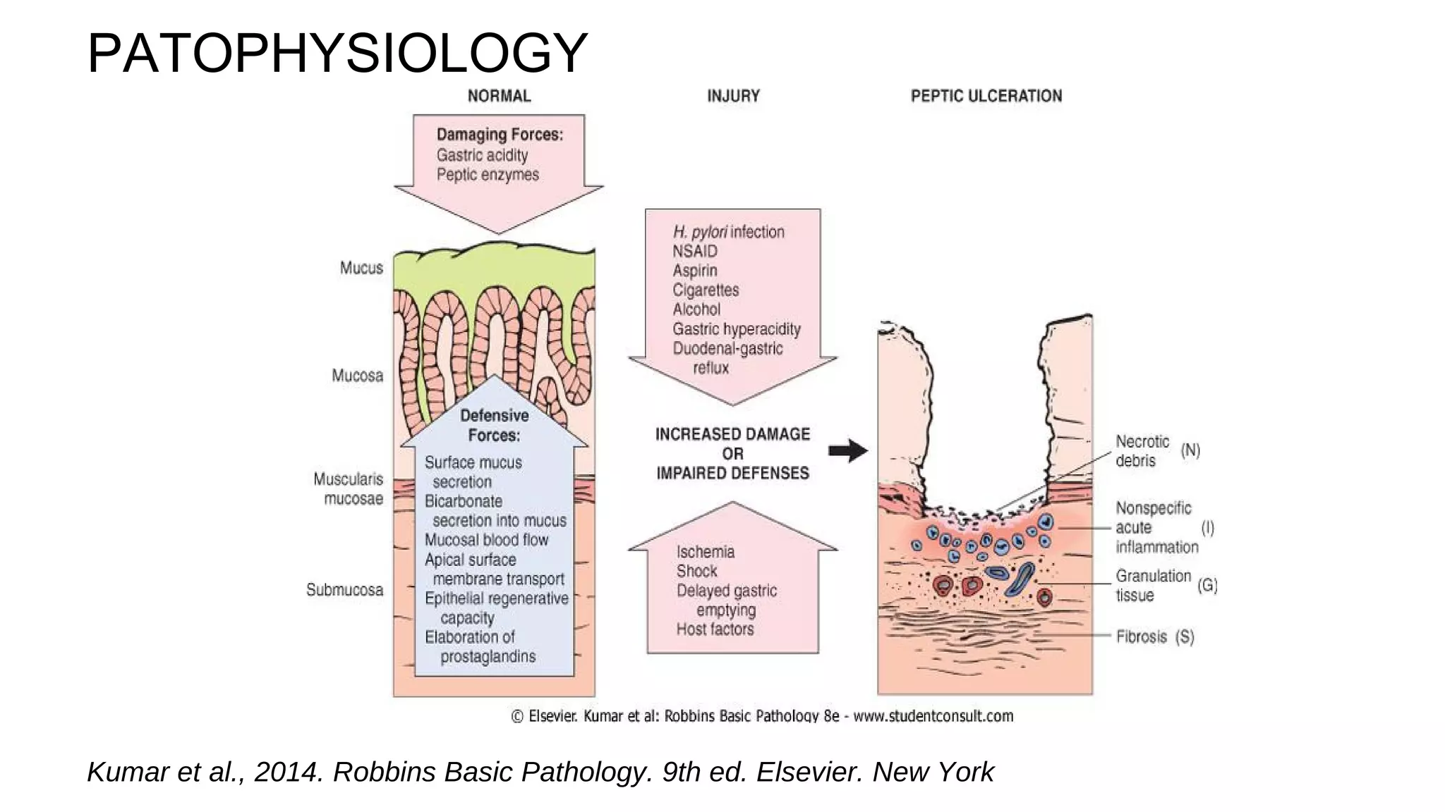 Gastric Perforation | PPT
