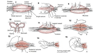 Gastric Perforation | PPT