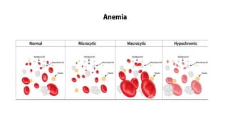 A CASE PRESENTATION ON IRON DEFICIENT ANEMIA | PPTX
