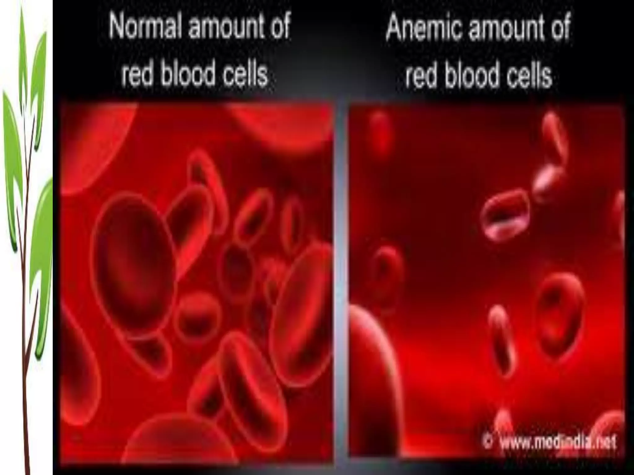 Anemia ppt | PPTX