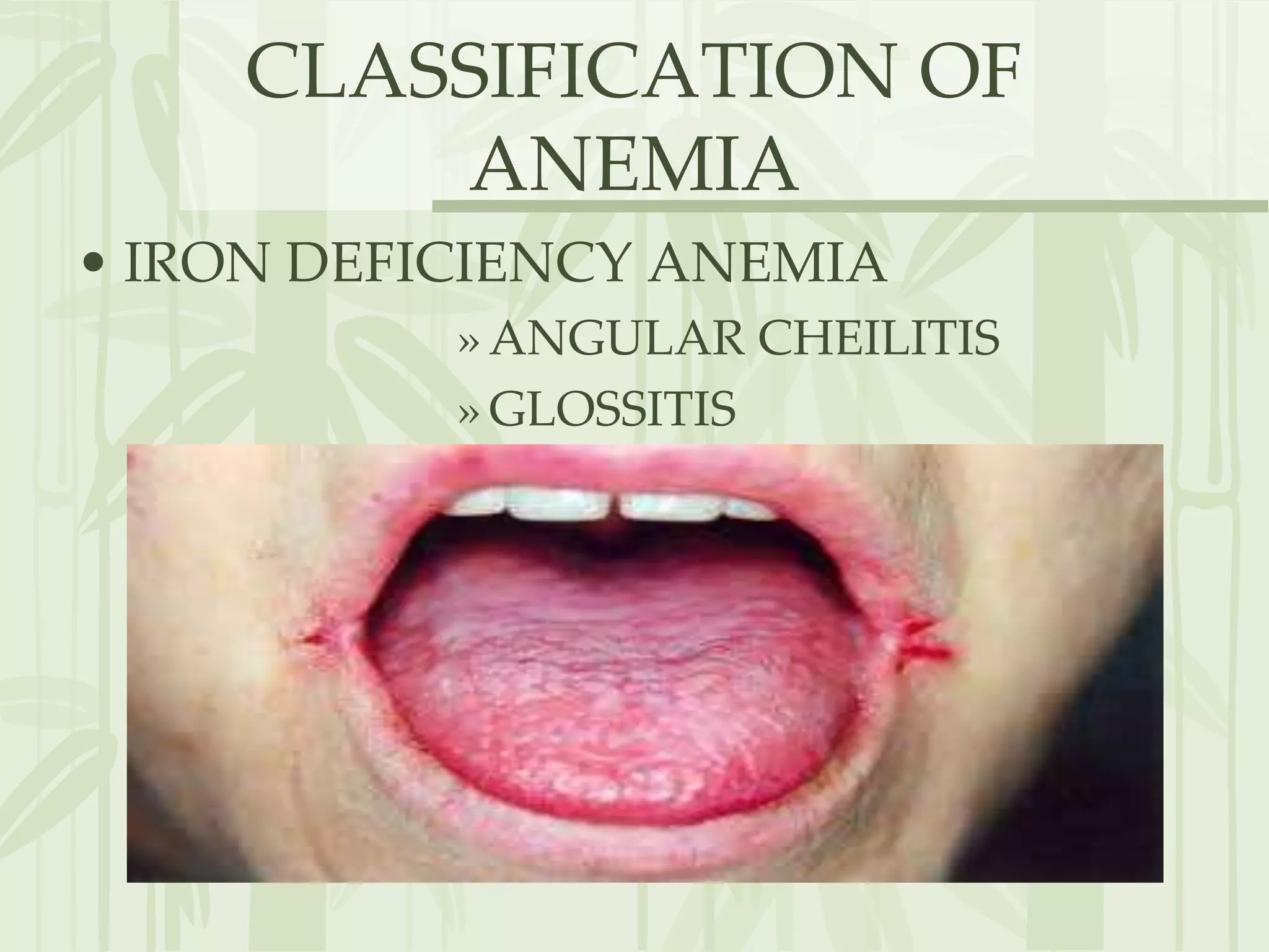 Anemia by anukannan | PPTX