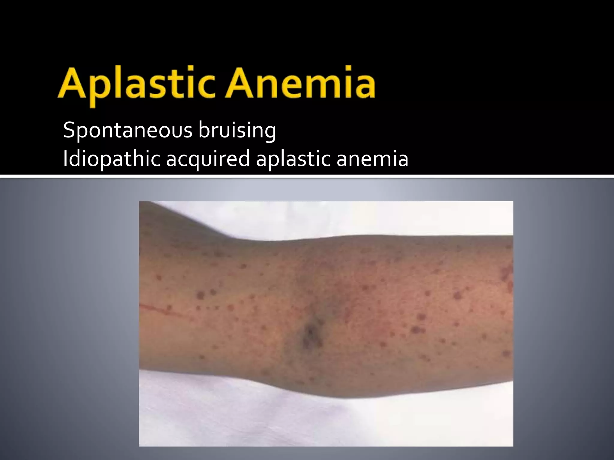 Anemia | PPTX
