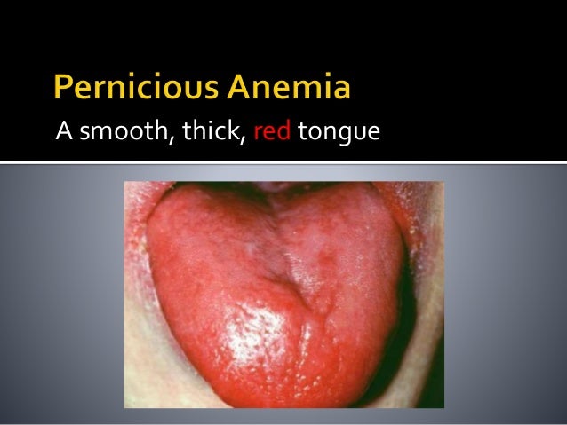 Anemia