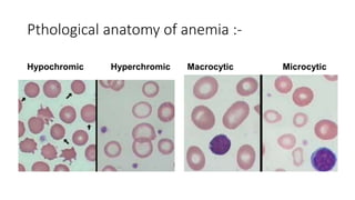 Anemia | PPT