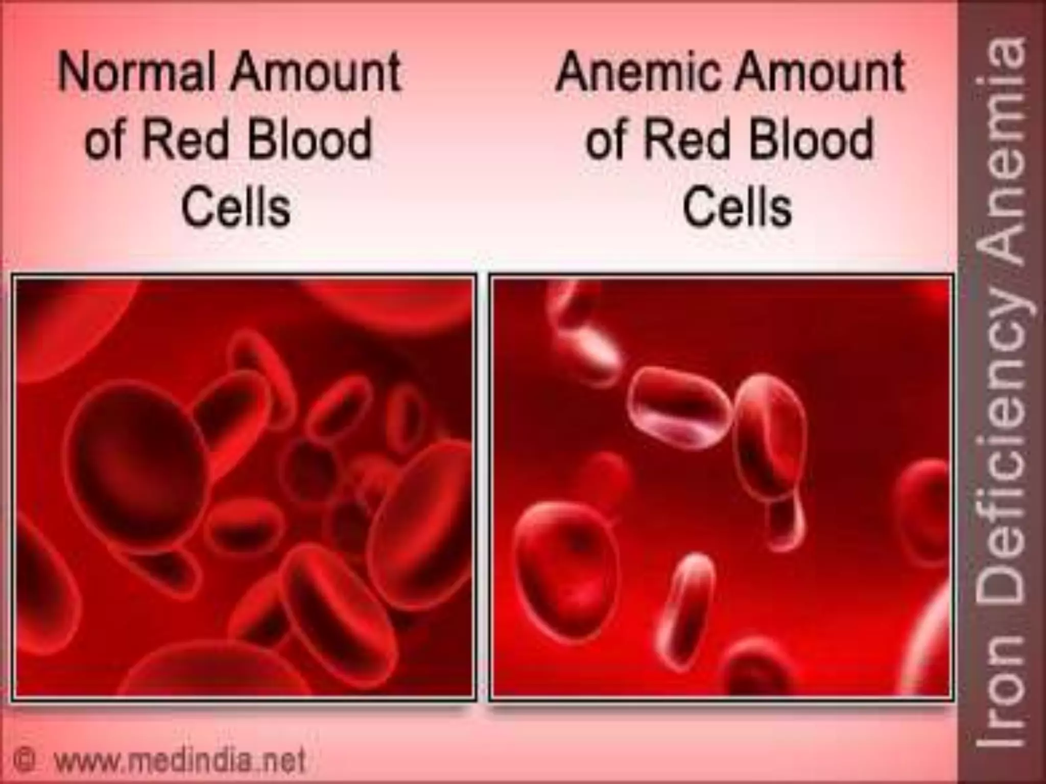 Anemia | PPTX | Blood Disorders | Diseases and Conditions
