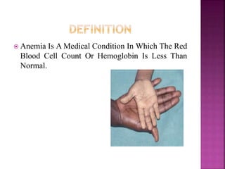 Anemia | PPTX