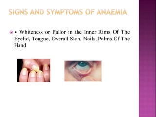 Anemia | PPTX