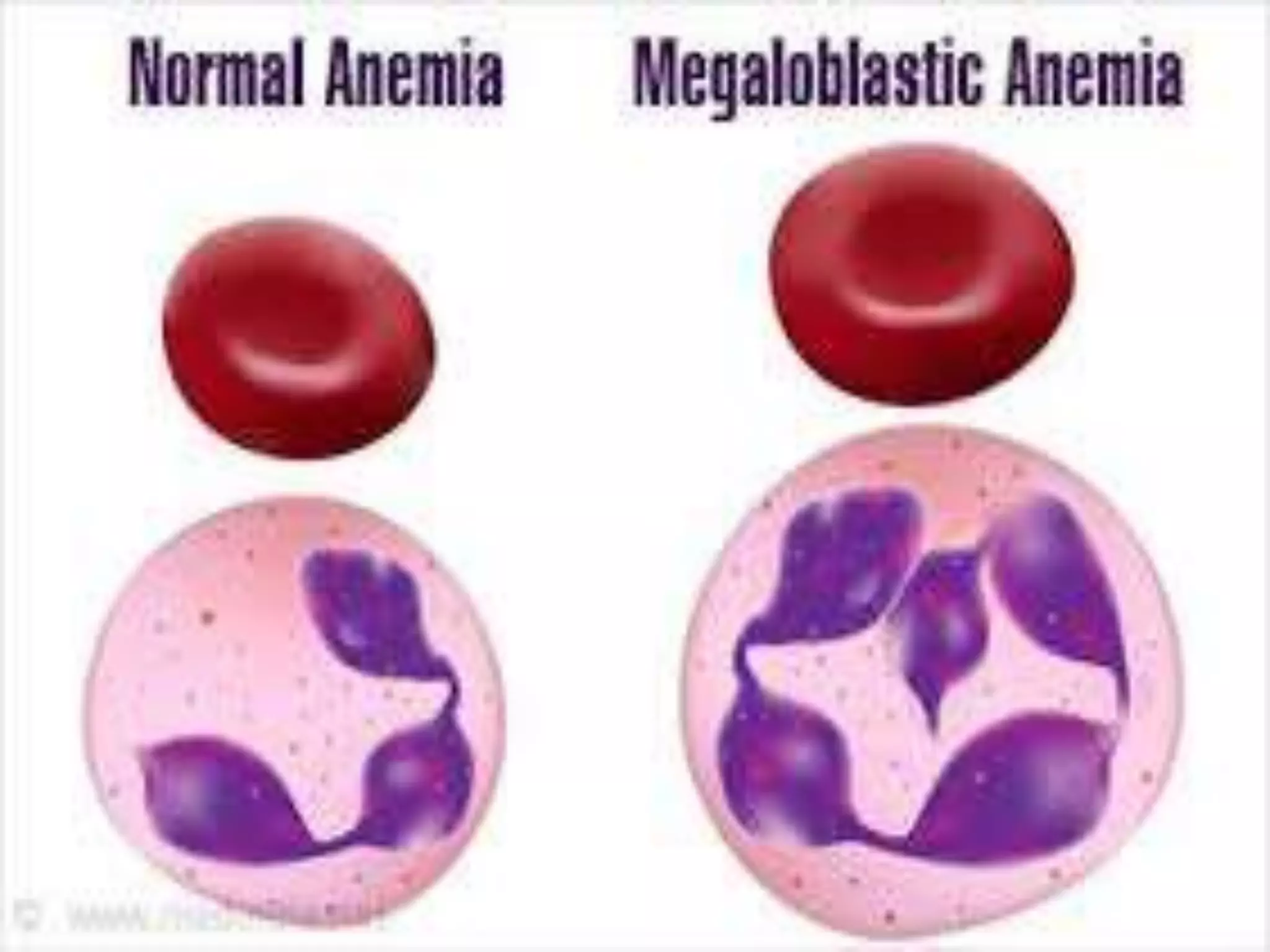 Anemia in child | PPTX
