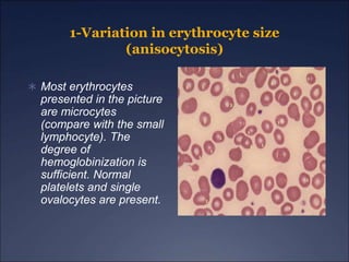 Anemia | PPT