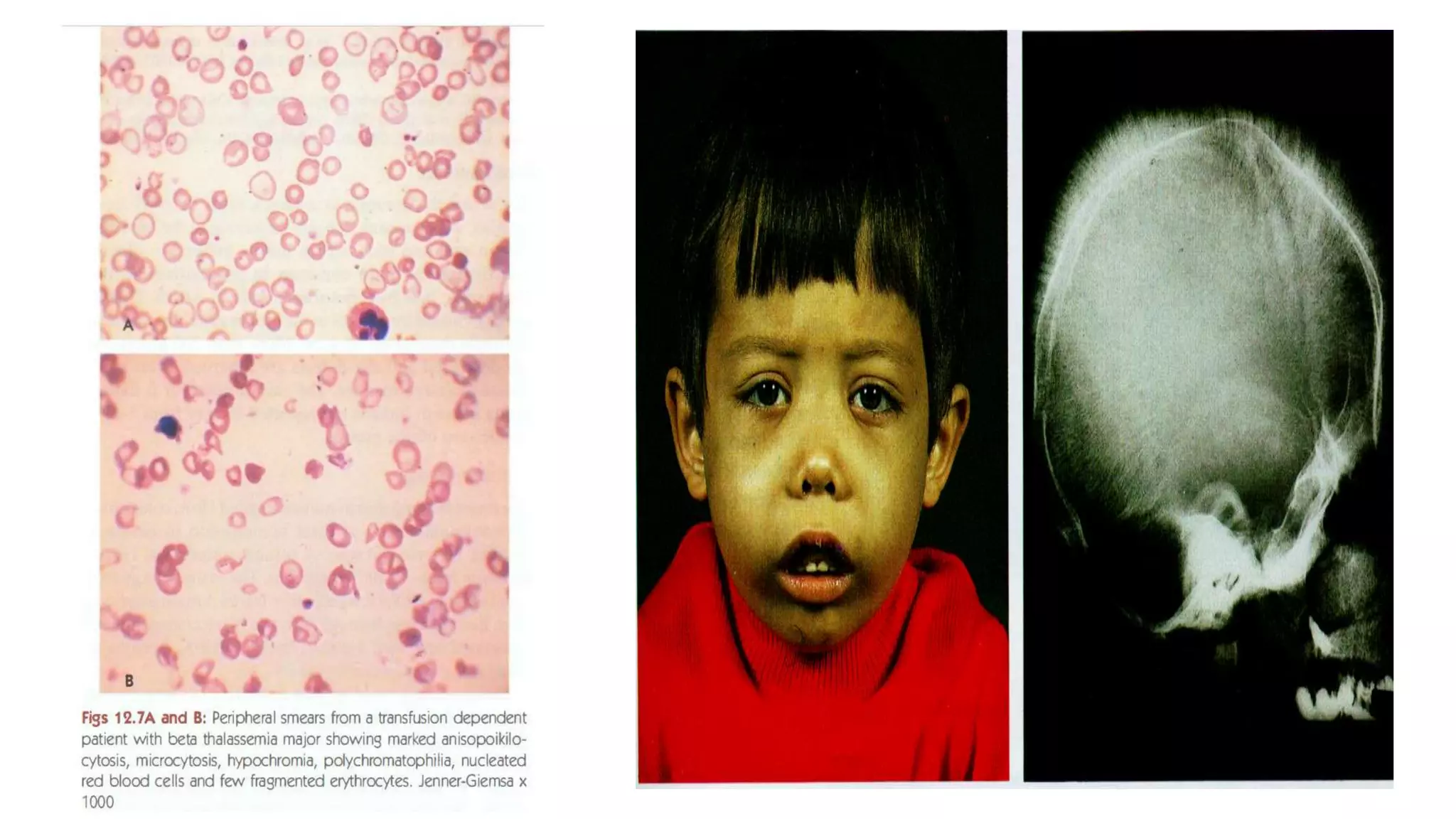 Anemia In Childhood | PPTX