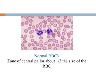 Anemia | PPTX