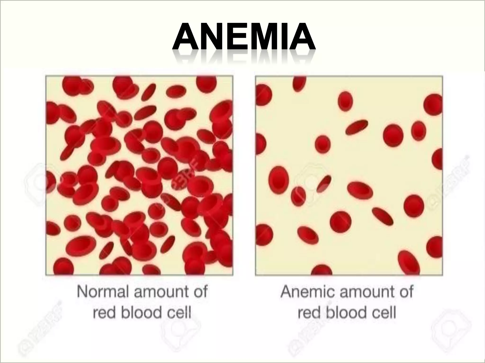 Anemia | PPT