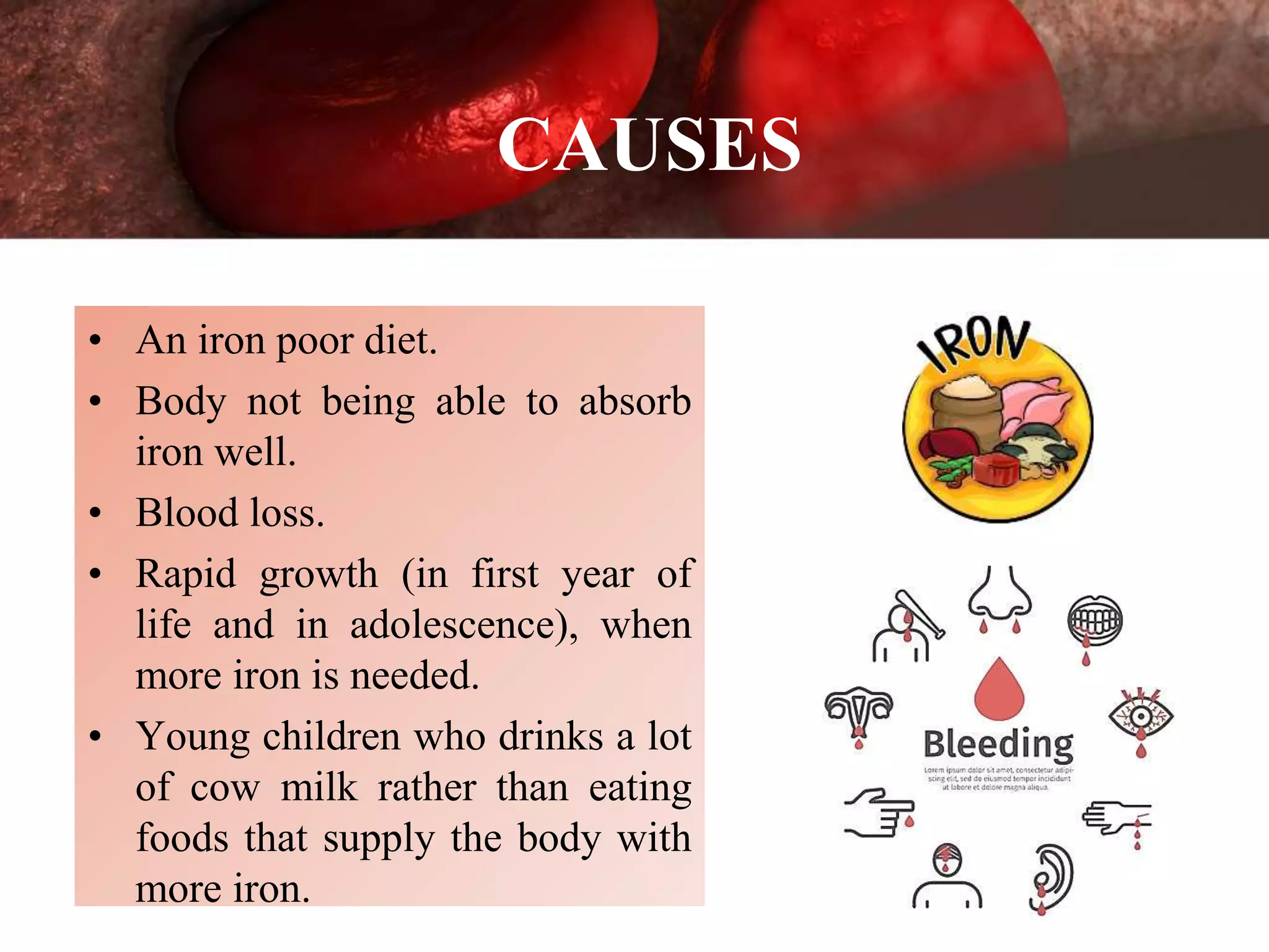 ANEMIA IN PEDIATRICS: IRON DEFICIENCY ANEMIA, MEGALOBLASTIC ANEMIA ...