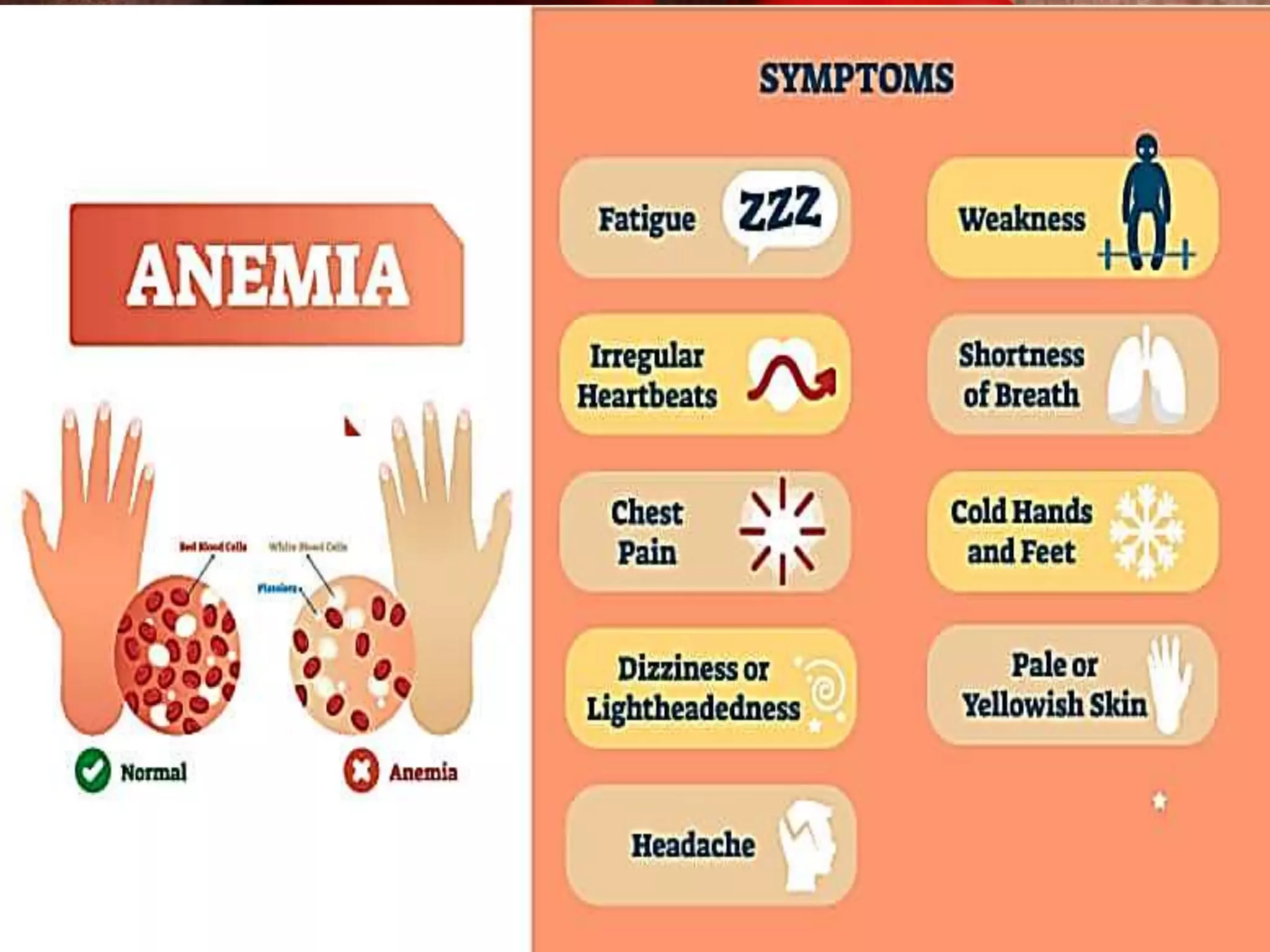 ANEMIA IN PEDIATRICS: IRON DEFICIENCY ANEMIA, MEGALOBLASTIC ANEMIA ...