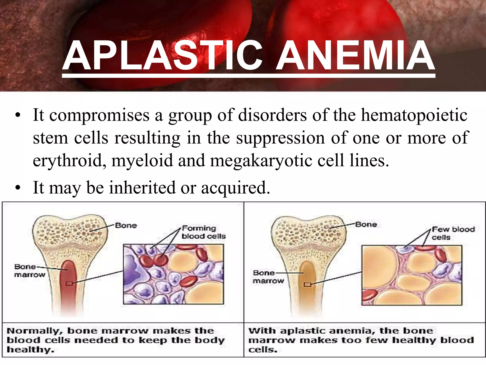 ANEMIA IN PEDIATRICS: IRON DEFICIENCY ANEMIA, MEGALOBLASTIC ANEMIA ...