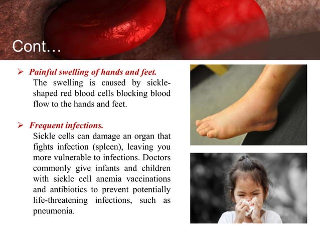 ANEMIA IN PEDIATRICS: IRON DEFICIENCY ANEMIA, MEGALOBLASTIC ANEMIA ...