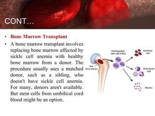 Sickle Cell Anemia Bone Marrow Transplant