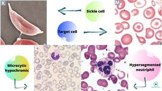 Overview of Anemia | PPT