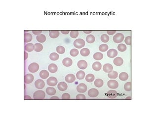 anemia.pptx