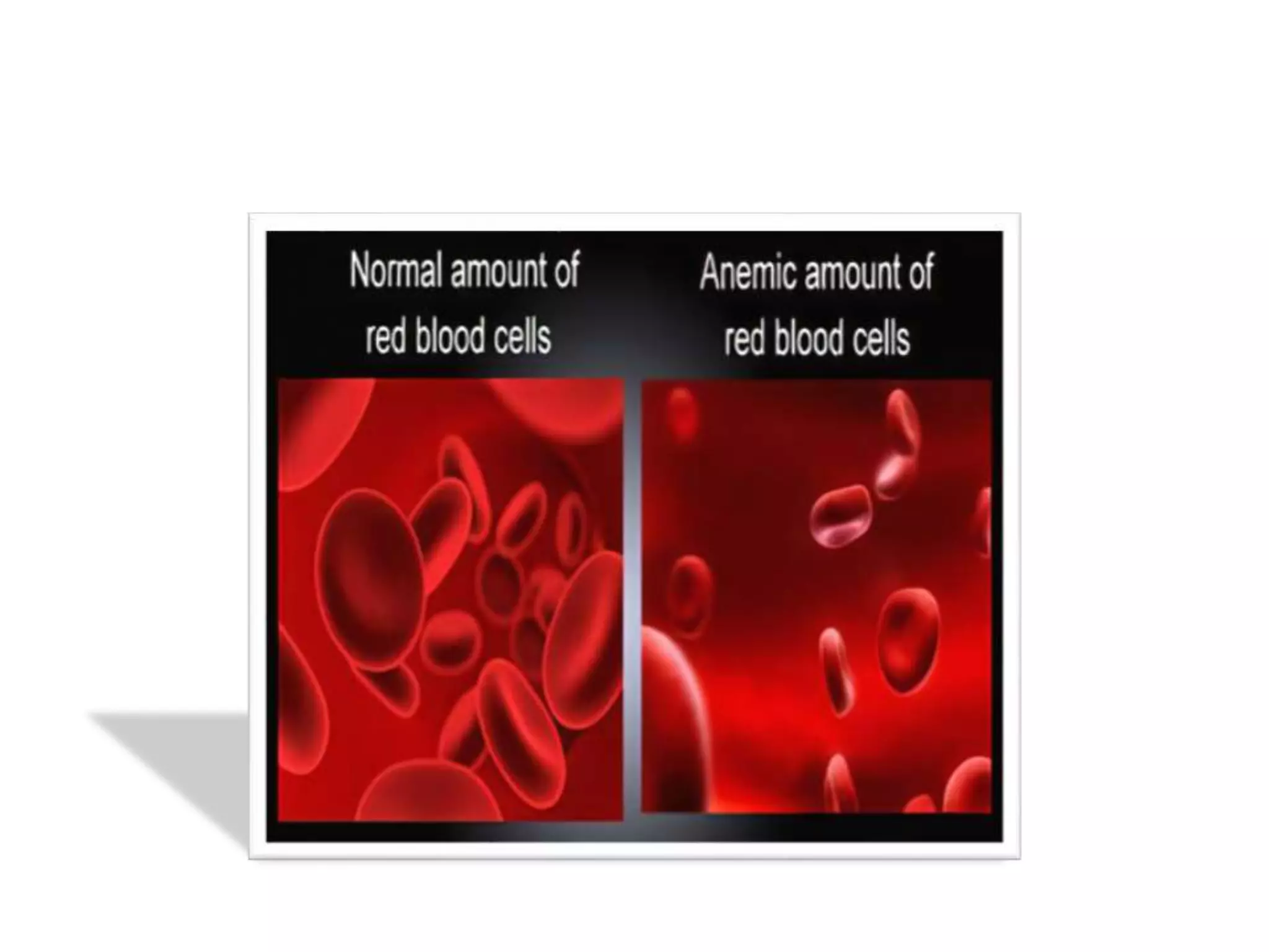 ANEMIA its types.pptx
