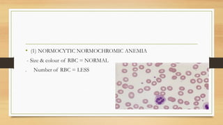 Anemia.pdf