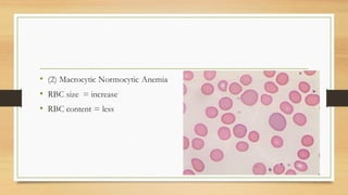 Anemia.pdf