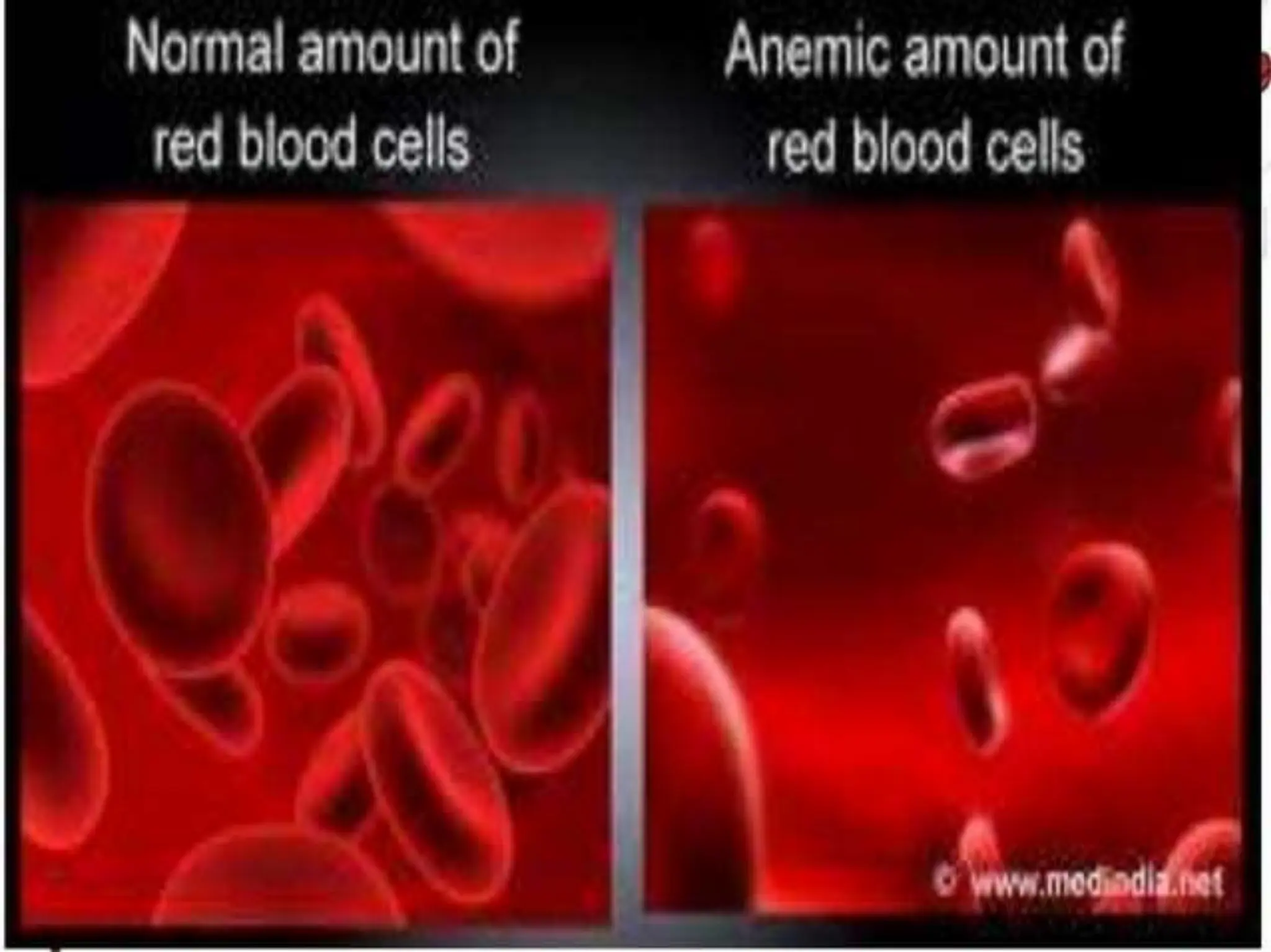 ANEMIA.pptx anemia notes for nursing students | PPTX