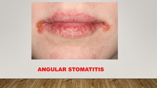 ANEMIA .pptx | Blood Disorders | Diseases and Conditions