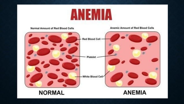 Types of anemia and its cure with diet chart | PPT