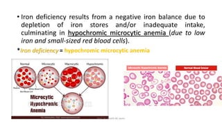 iron deficiency Anemia and treatment .pdf